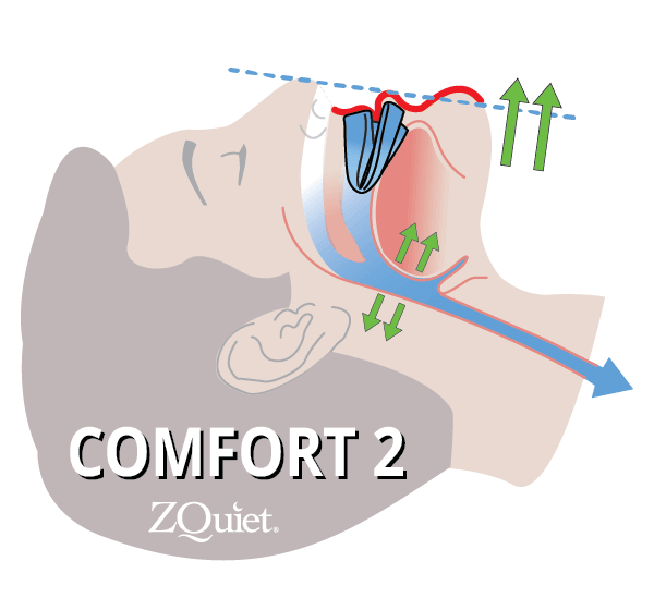 Anti Snoring Mouthpiece Starter Pack And Sleep Mouthpiece Zquiet