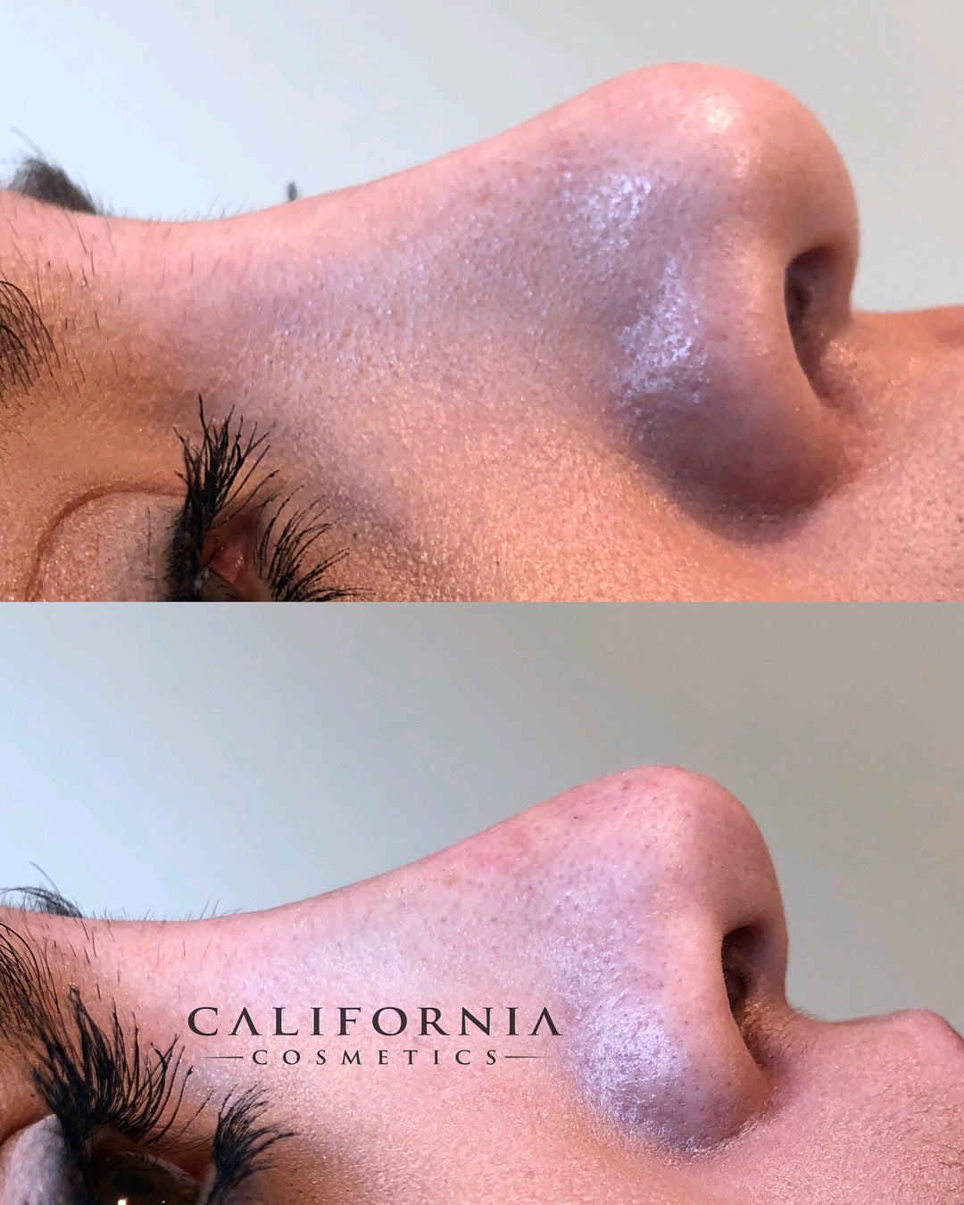 Liquid Nose Job Non Surgical Rhinoplasty Newport Beach And Corona