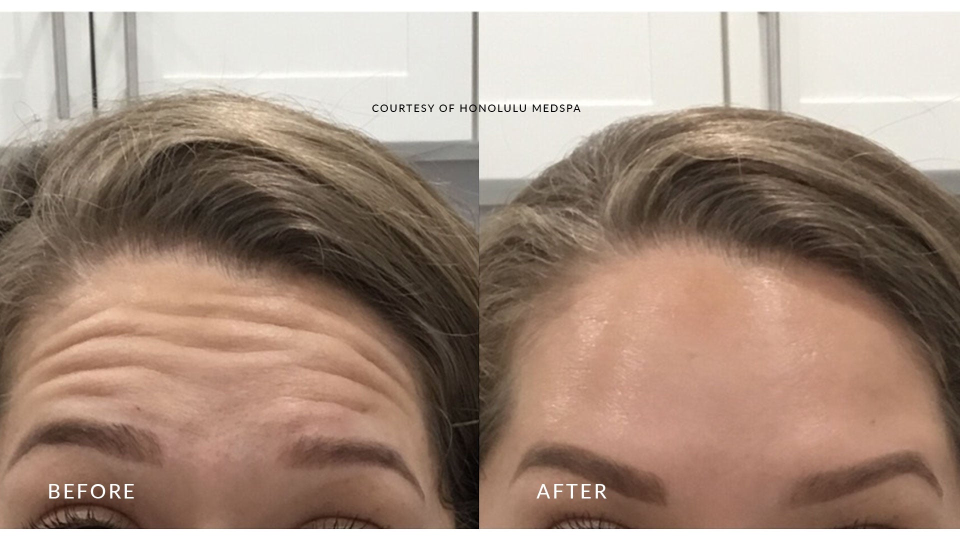 Botox® For Fine Lines And Wrinkles