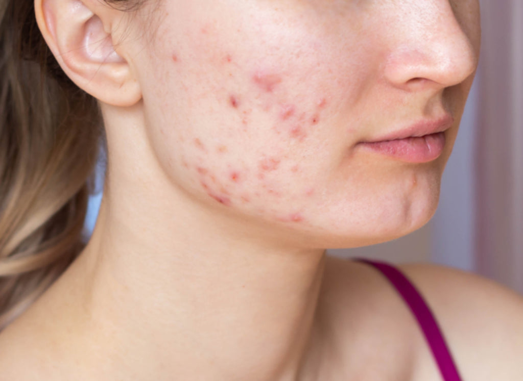 Natural Adult Acne Skin Care Tips Green People Uk