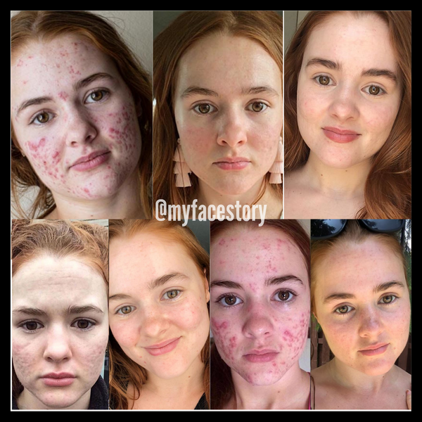 Accutane Before During And After