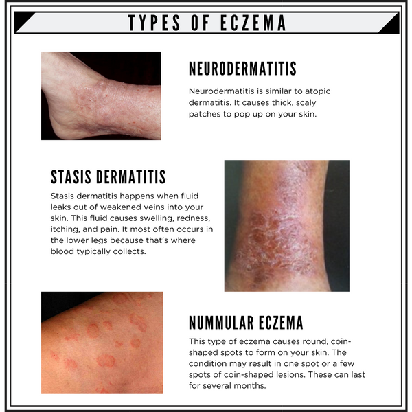 7 Types Of Eczema Pictures And Differences Between Them