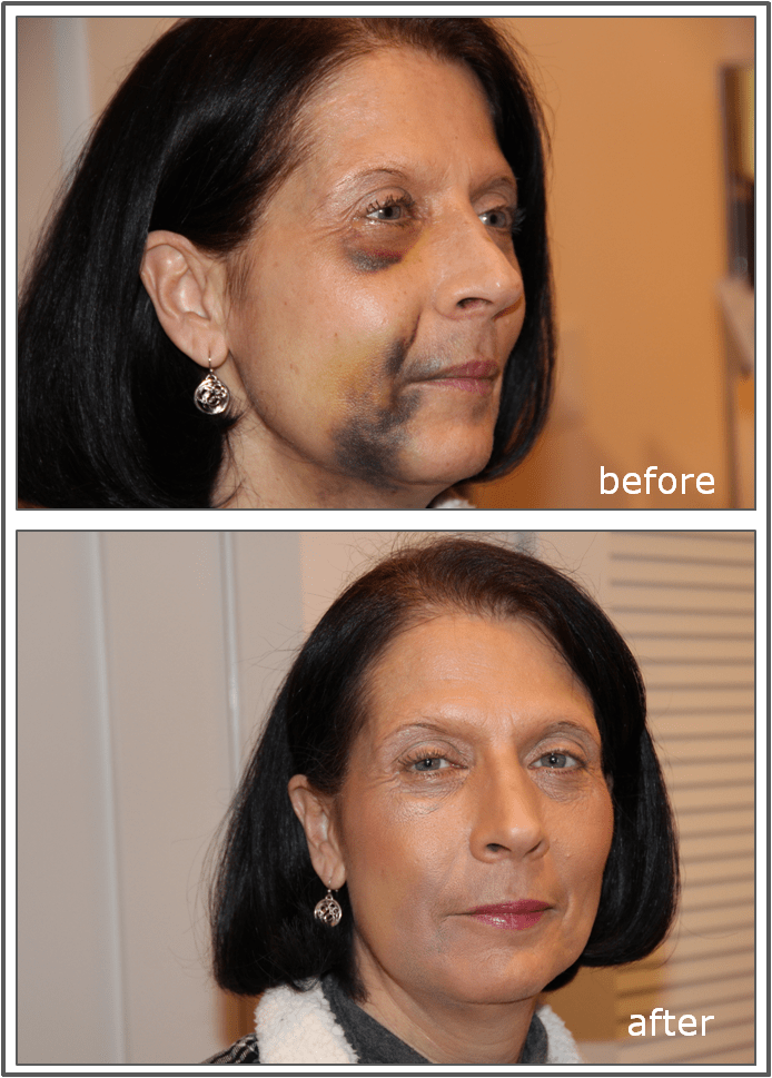 How To Cover Up Bruising With Makeup Jane Iredale