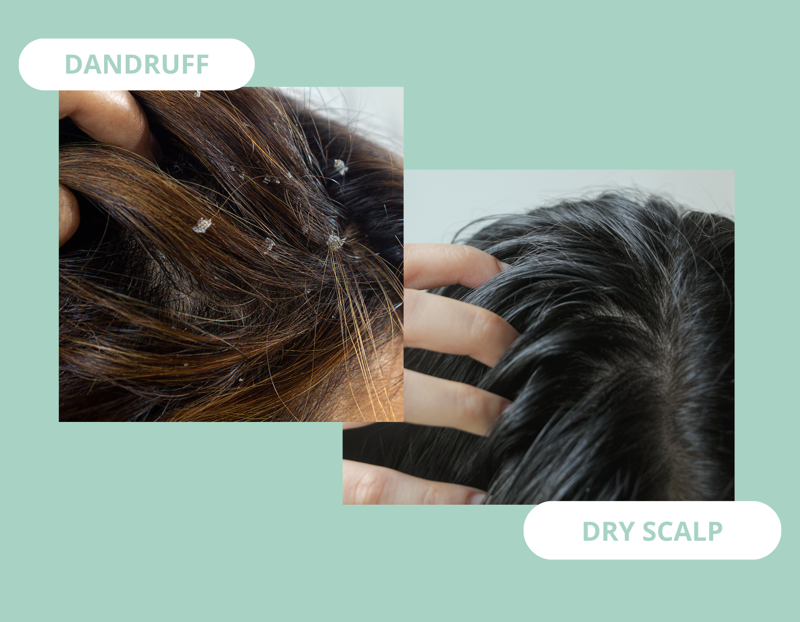 Dandruff Vs Dry Scalp L The Comprehensive Comparison And Treatments