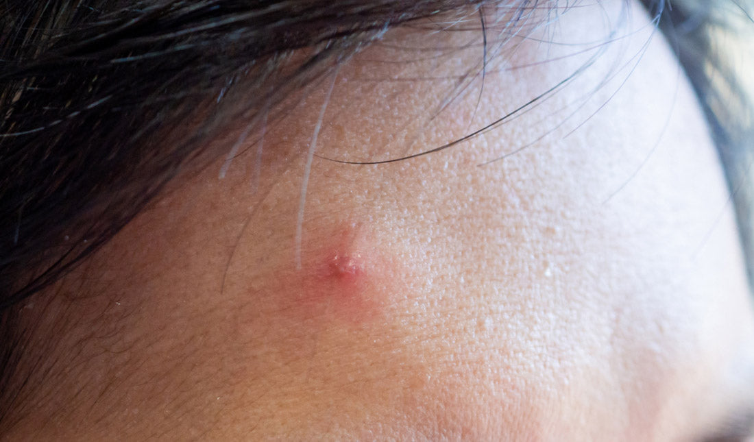 Nodular Acne Symptoms Causes And How To Treat It