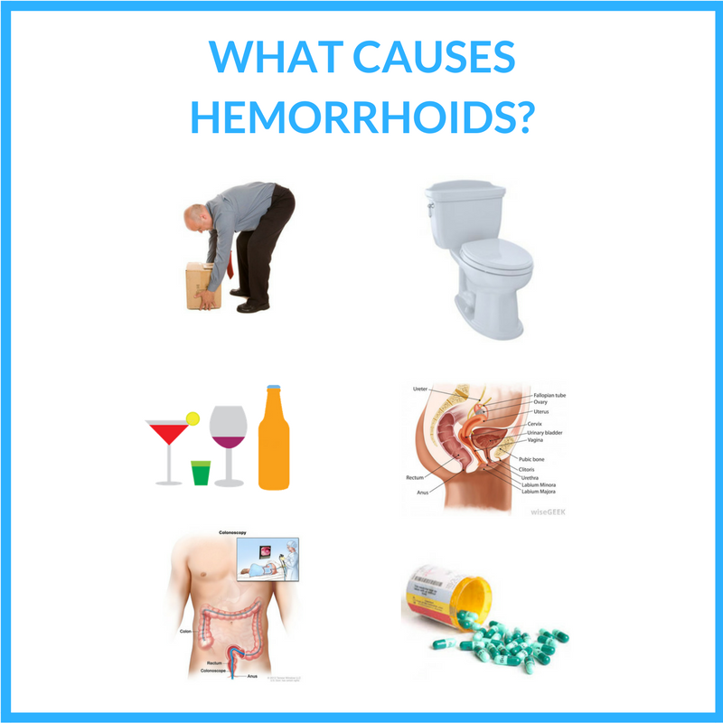 Hemorrhoid Causes Guide 101 Discover What Causes Hemorrhoids And How