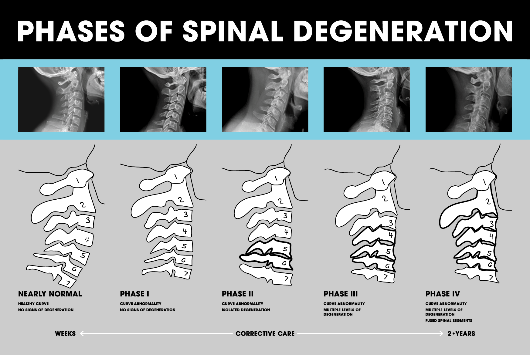 Spinal Degeneration Chart