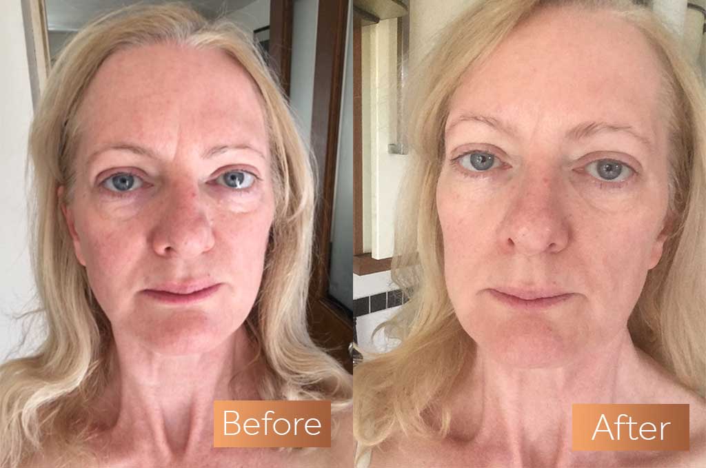 Absolute Collagen Before And After Pictures Incredible Results 2023