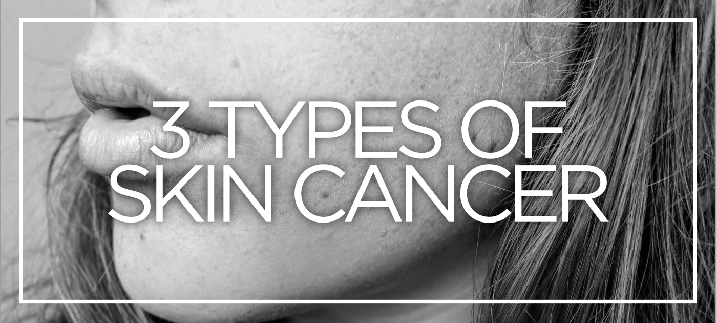 The 3 Types Of Skin Cancer You Need To Know Sparms Sun Protection