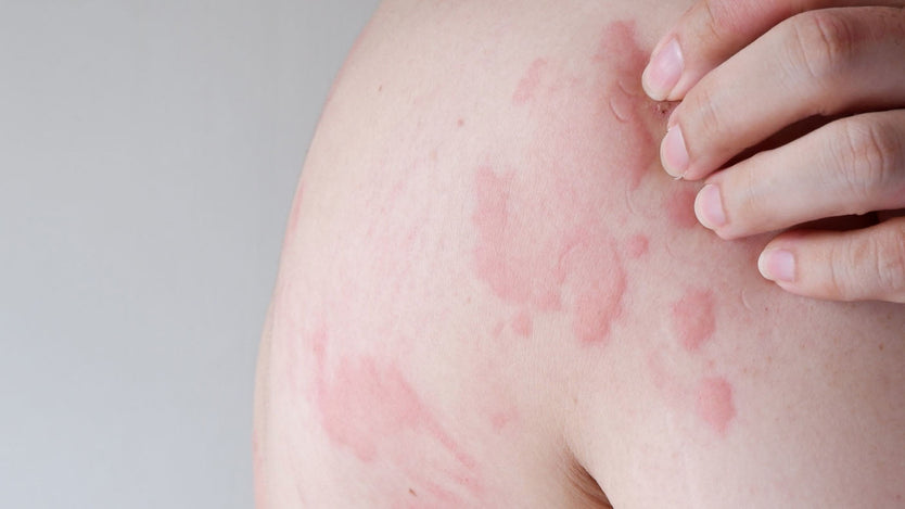 Urticaria And Hives Symptoms And Causes Pai Skincare Uk