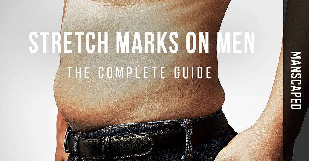 Stretch Marks On Men The Complete Guide Manscapedcom