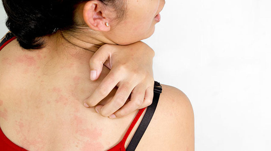 How To Get Rid Of Hives What Causes Hives Itch Relief Urticaria