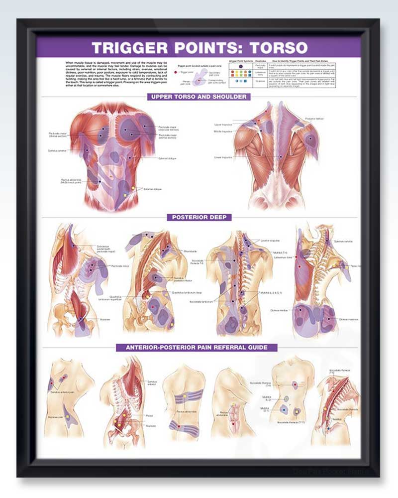 Trigger Points Set Exam Room Anatomy Posters Clinicalposters