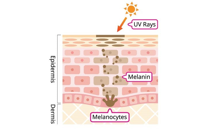 Hyperpigmentation Causes Types Treatments Prevention Tips Skinkraft