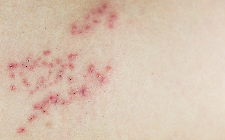 What Causes Red Spots On Skin And How To Treat Them Skinkraft