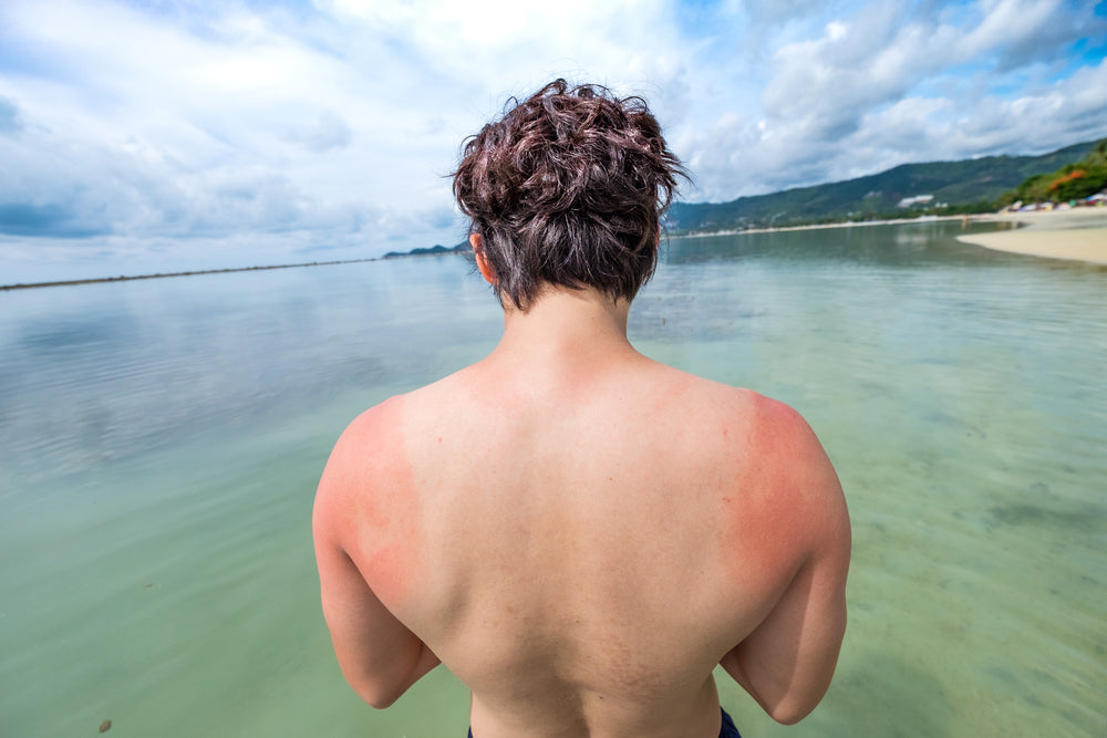 4 Natural Remedies To Treat Sunburn Herb Affair