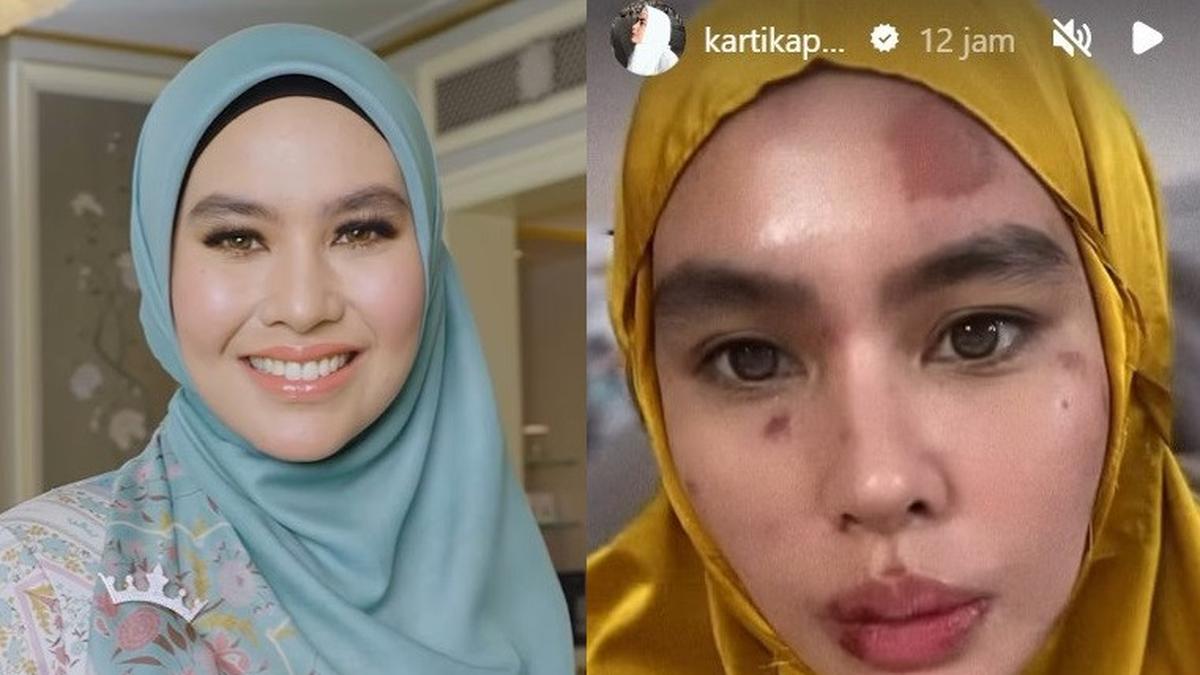 Wajah Cantik Kartika Putri Penuh Ruam Dan Lidah Melepuh Tiba Tiba