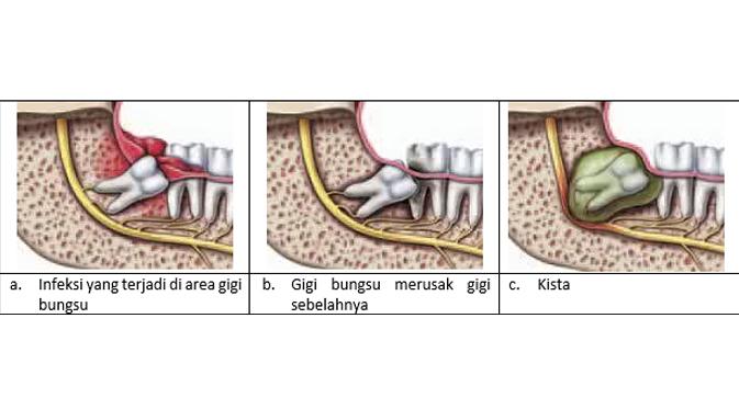 Benarkah Gigi Bungsu Berbahaya Health