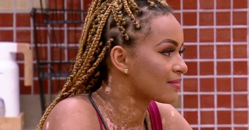 Entenda O Que é Vitiligo A Doença Da Natália Do Bbb 22 Primeira Página