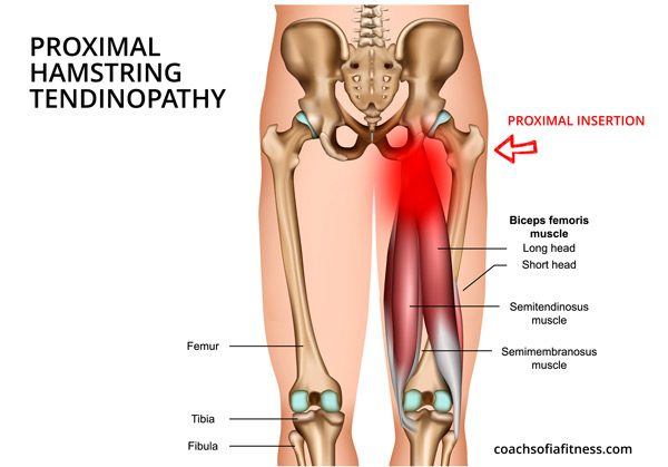 Hamstring Tendonitis Rehab Exercises For Relief Coach Sofia Fitness