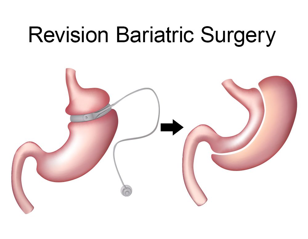 Revision Bariatric Surgery Tijuana Mexico Oasis Of Hope Bariatrics