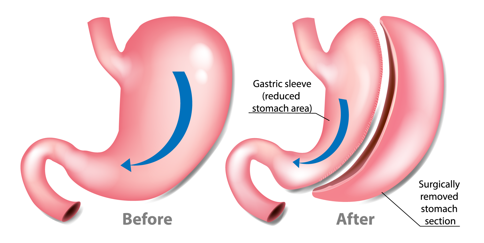 Gastric Sleeve Complications Tijuana Mexico Dr Francisco Gonzalez