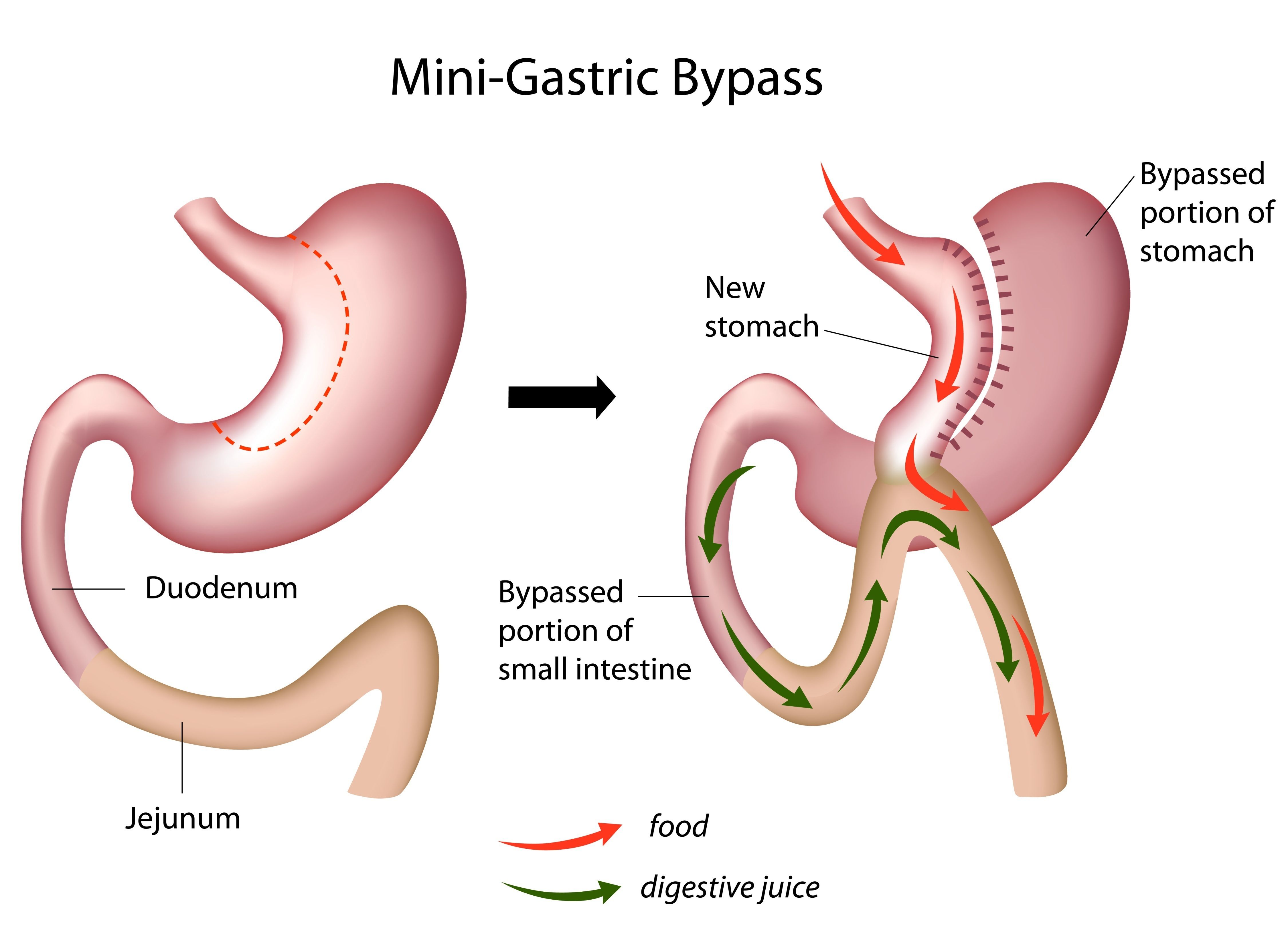 Tijuana Gastric Sleeve Vs Mini Gastric Bypass Surgery Bariatric