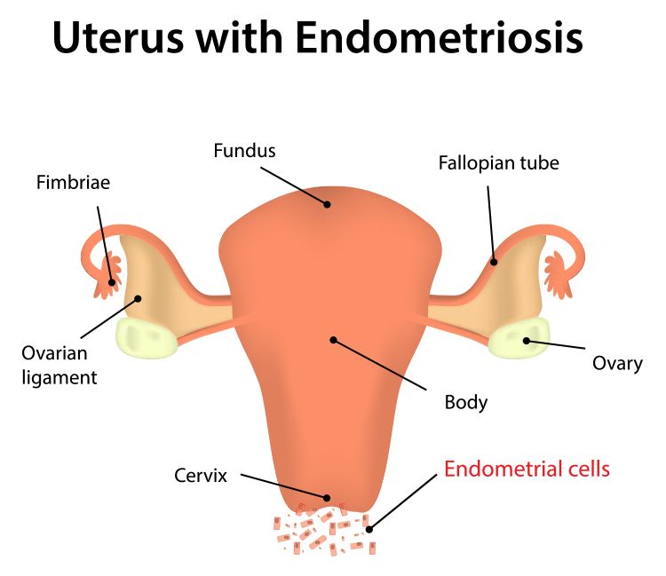 Fertility Treatment For Endometriosis Los Angeles Ca