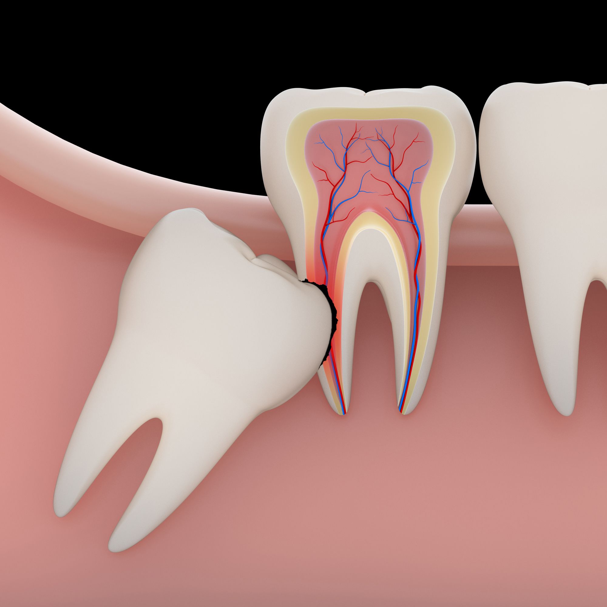 Impacted Wisdom Tooth Removal Bolingbrook Il Extraction