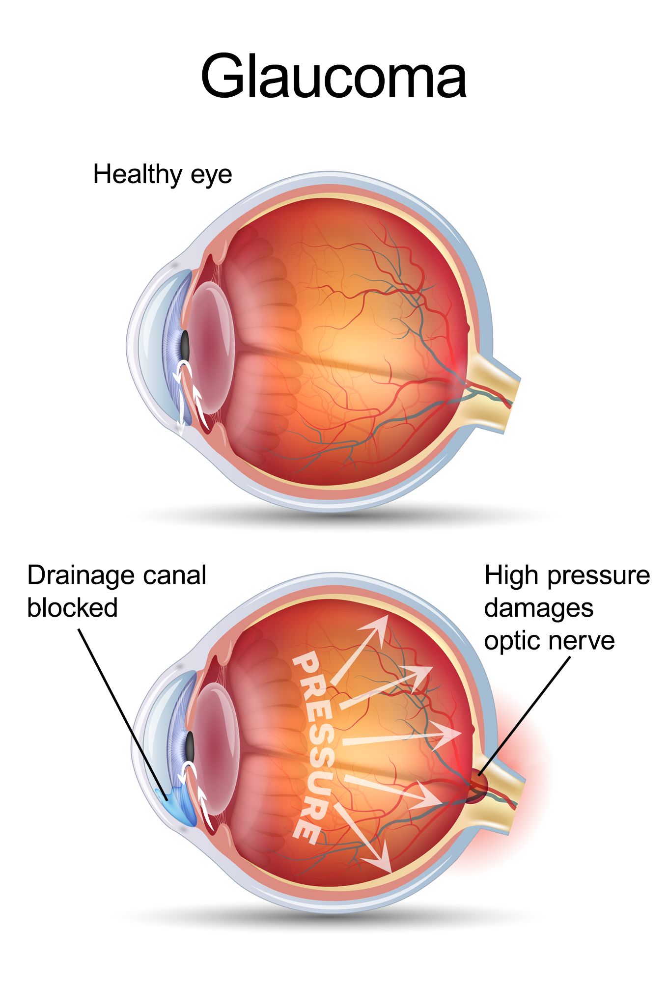 Glaucoma Diagnosis