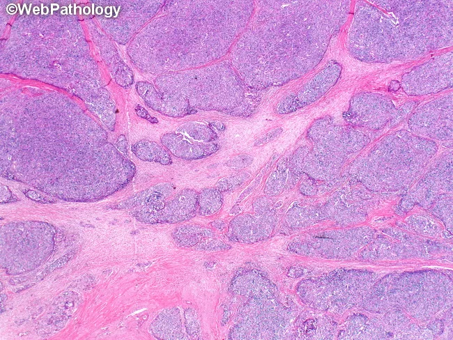 Type B2 Thymoma Presentation