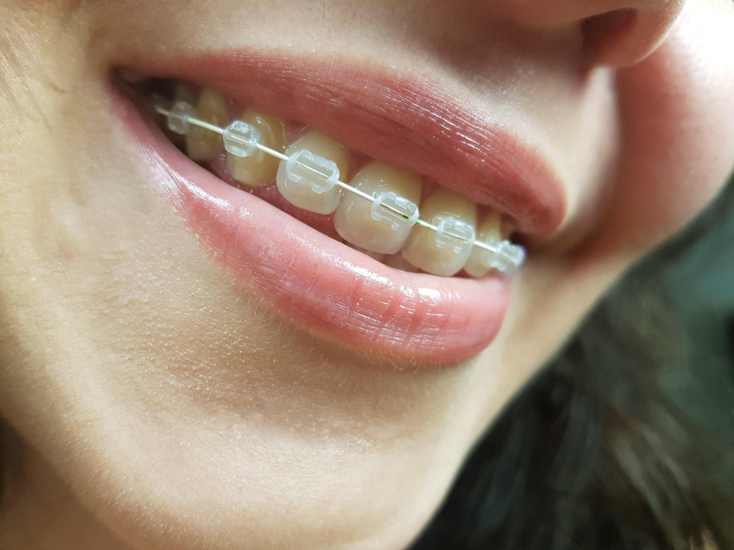 Two Phase Treatment Matteson Orthodontics