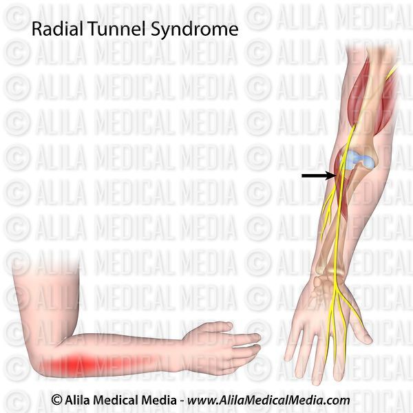 Alila Medical Media Syndrome Du Tunnel Radial Illustration Médicale