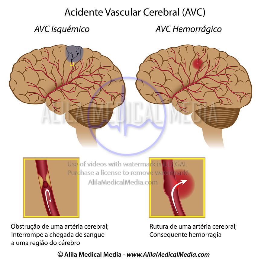 Alila Medical Media Acidente Vascular Cerebral Avc Medical