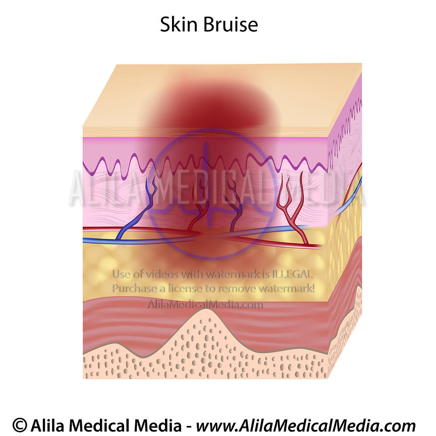 Alila Medical Media Skin Bruise Diagram Medical Illustration