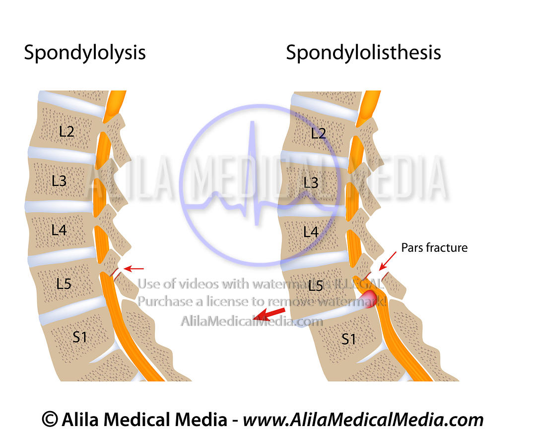 Alila Medical Media Lumbar Spine Labeled Diagram Medi