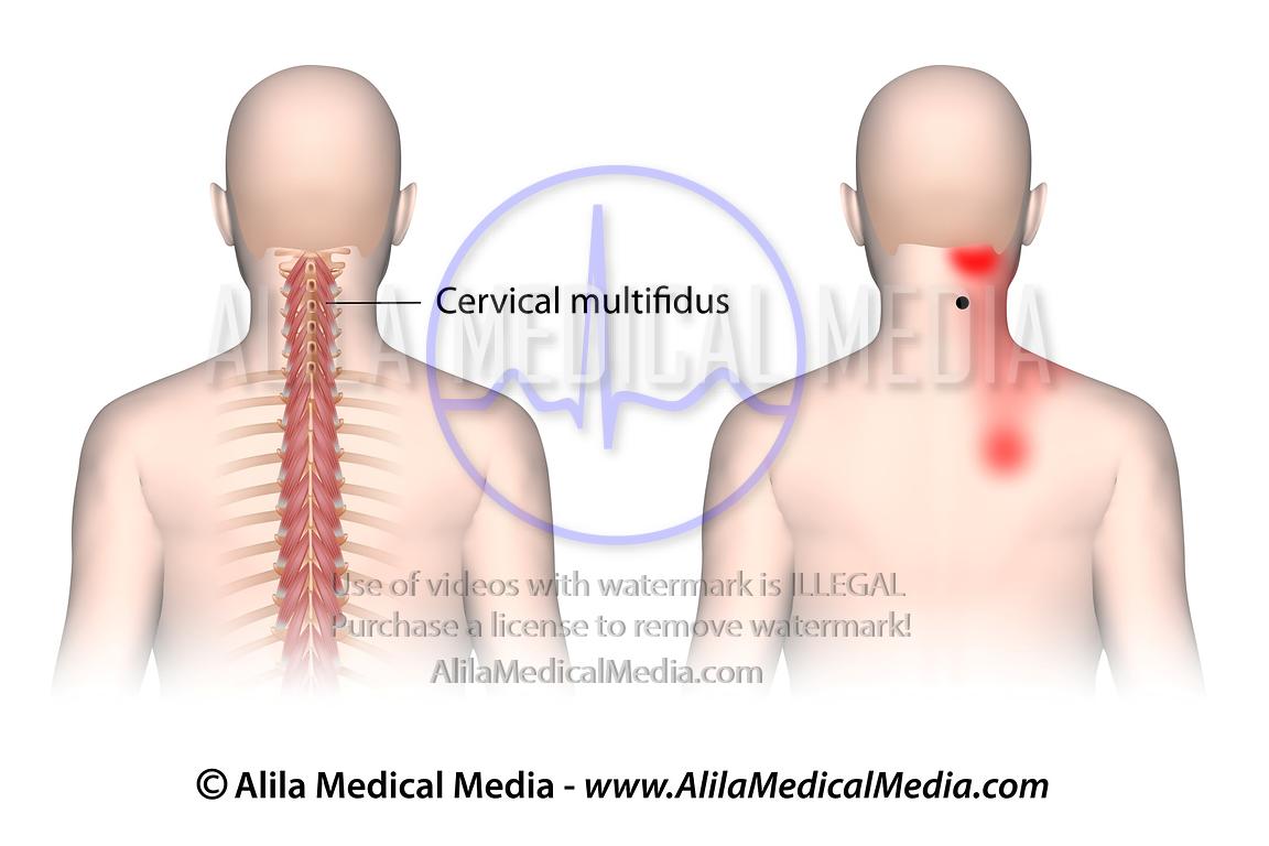 Alila Medical Media Trigger Points And Referred Pain Patterns For The