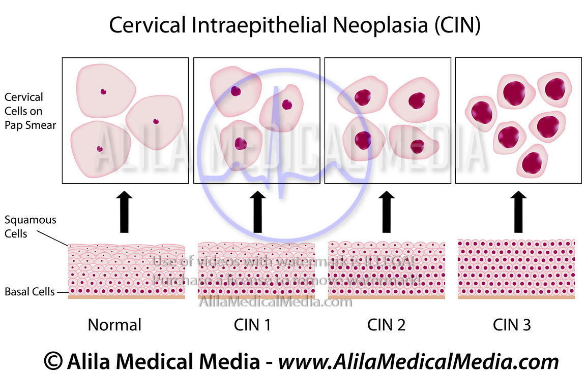 Stages Of Cervical Cancer Chart