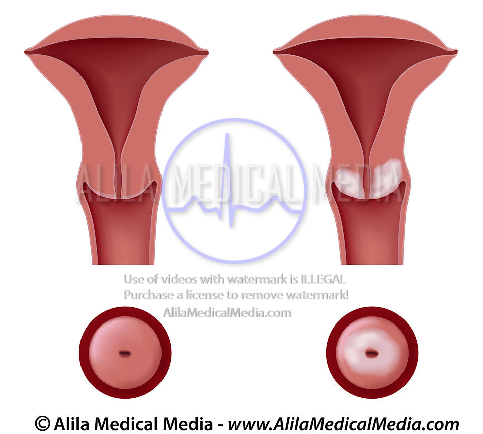 Alila Medical Media Cervical Cancer Unlabeled Diagram Medical