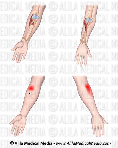 Alila Medical Media Trigger Points And Referred Pain For The