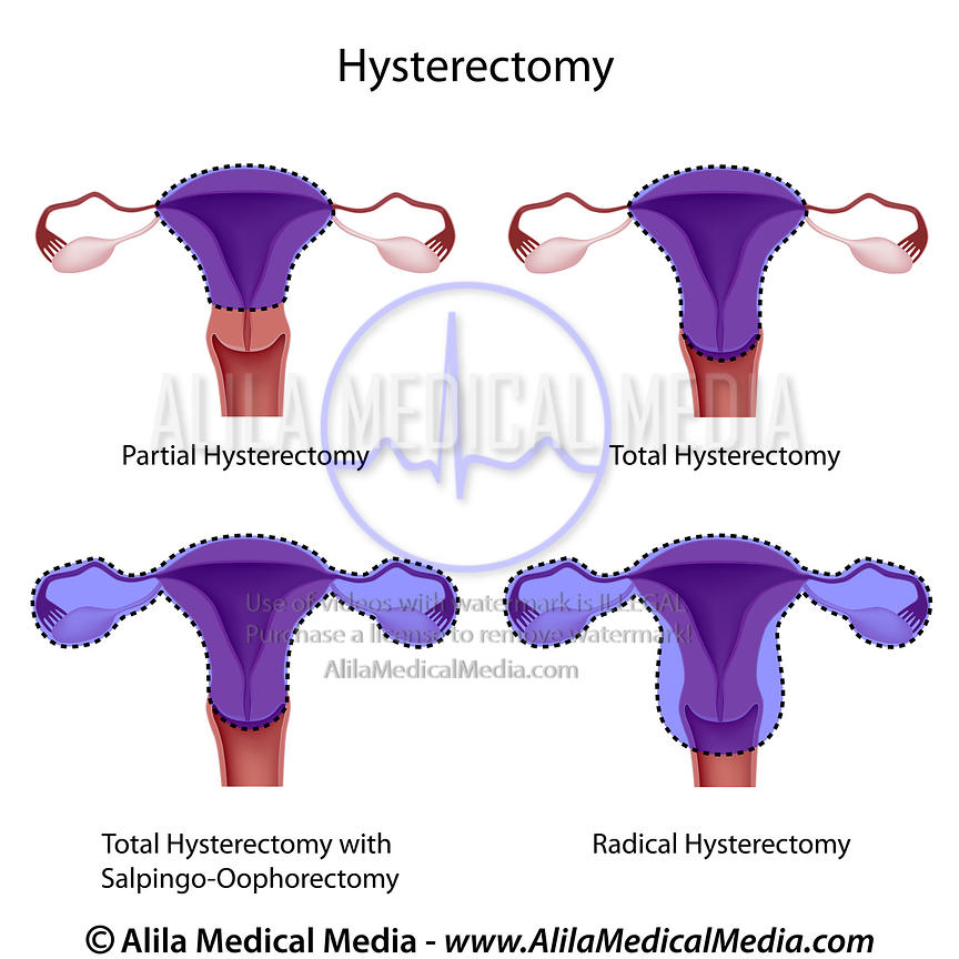 Alila Medical Media Hystérectomie Ablation Chirurgicale De Lutérus