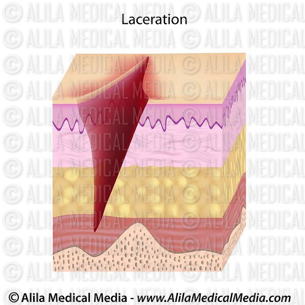 Alila Medical Media Laceration Drawing Medical Illustration