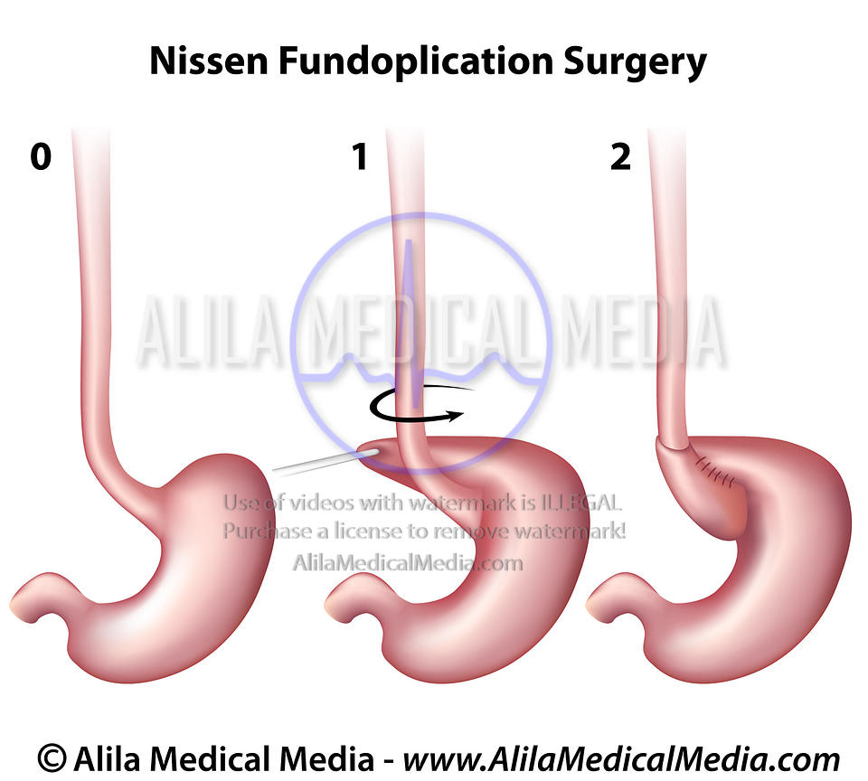 Alila Medical Media Nissen Fundoplication Surgery Medical Illustration