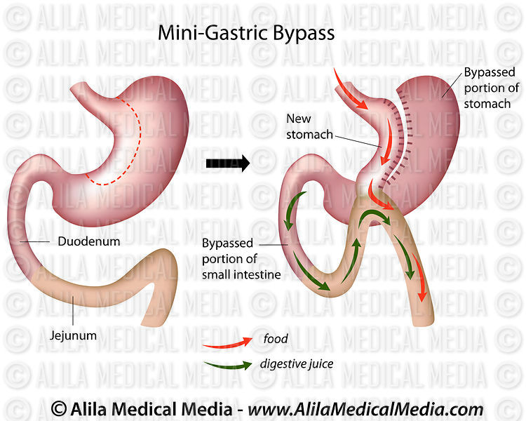 Alila Medical Media Nissen Fundoplication Surgery Medical Illustration