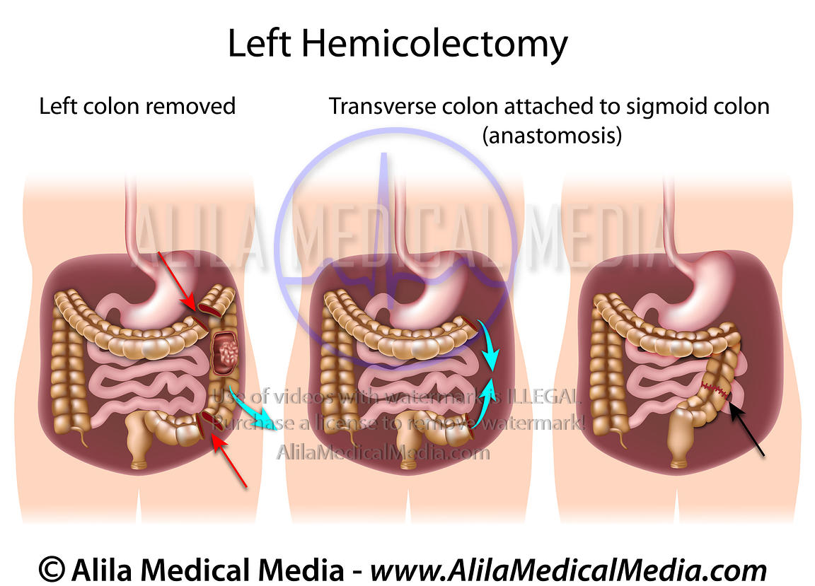 Alila Medical Media Left Hemicolectomy Medical Illustration