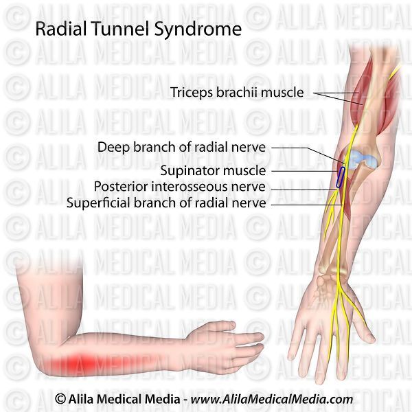 Alila Medical Media Radial Tunnel Syndrome Unlabeled Medical