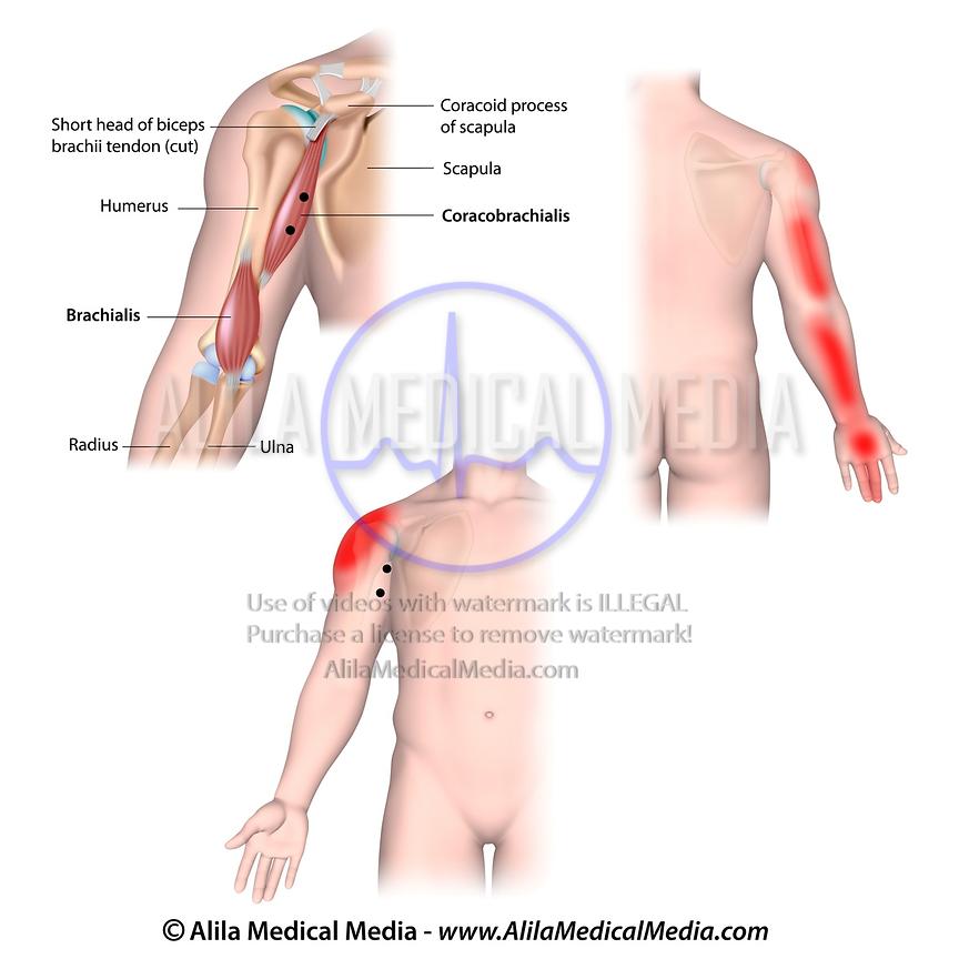 Alila Medical Media Trigger Points And Referred Pain For The