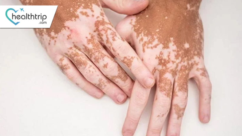 Comprehensive Guide To Vitiligo Treatment In India Top Hospitals