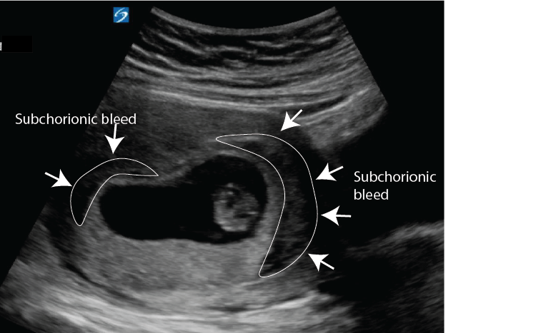 Subchorionic Bleed10 Week Pregnancy Critical Care Sonography