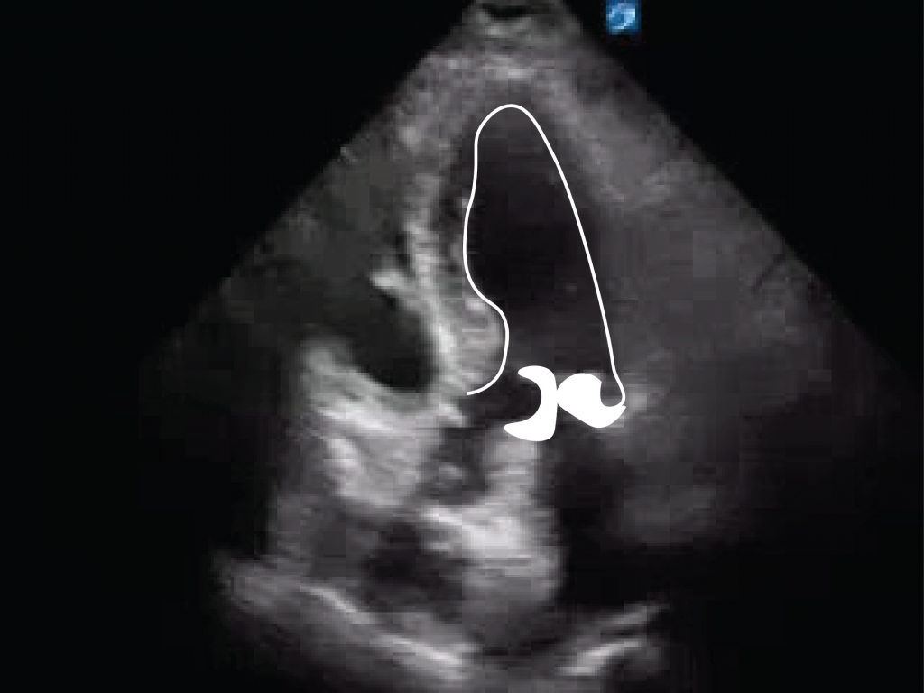 Systolic Anterior Motion Sam Critical Care Sonography